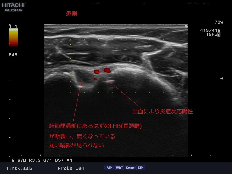 上腕二頭筋長頭腱断裂(LHB rupture) | ゆうき鍼灸接骨院