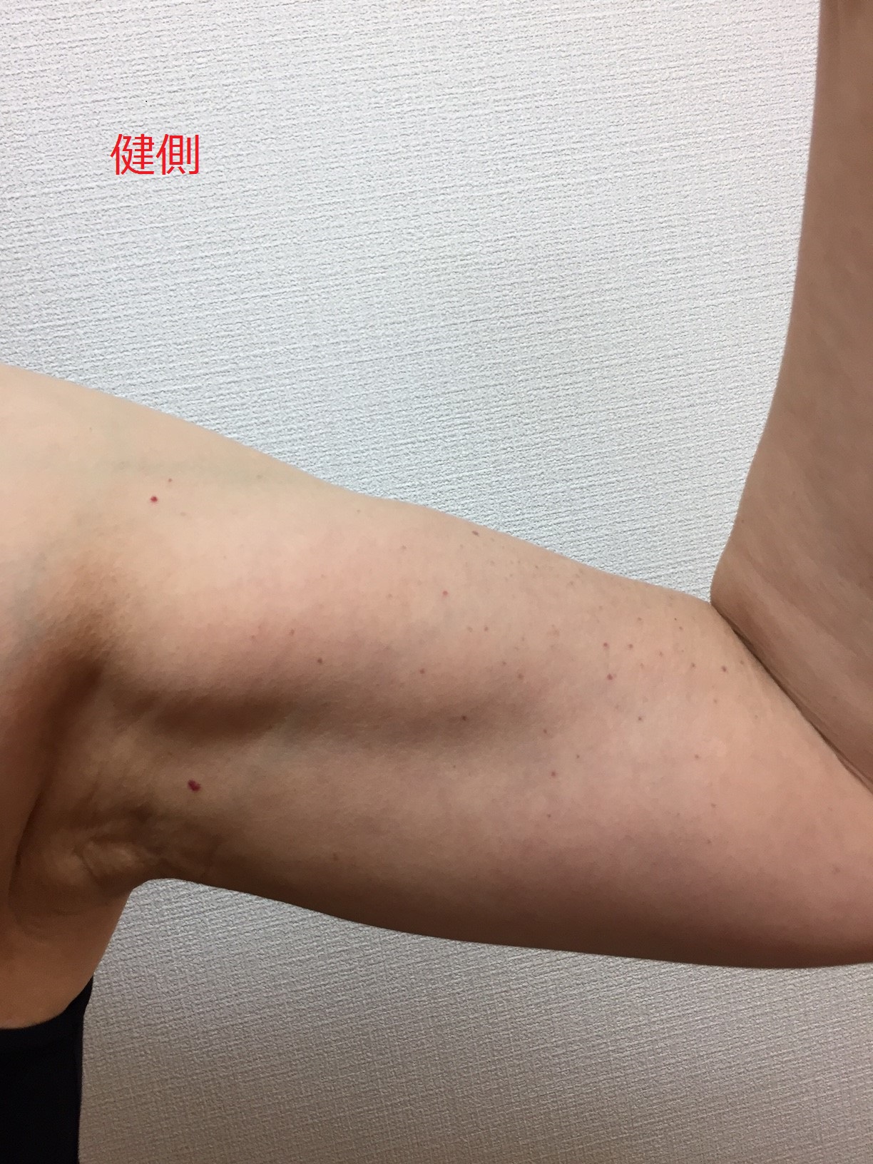 上腕二頭筋長頭腱断裂の症状について(LHB rupture) | ゆうき鍼灸接骨院